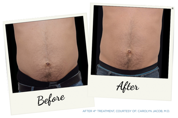 Before & After Pictures by Emsculpt® Providers - Burn Fat & Build Muscle