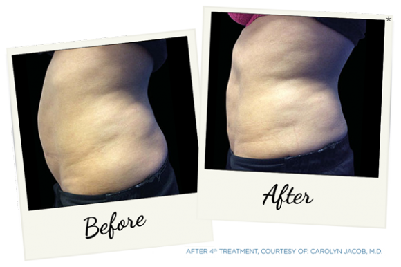 Before & After Pictures by Emsculpt® Providers - Burn Fat & Build Muscle