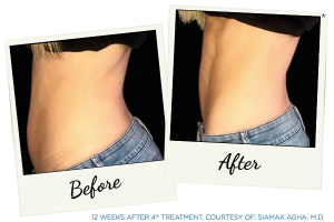 Before & After Pictures by Emsculpt® Providers - Burn Fat & Build Muscle