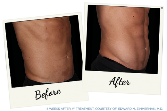 Before & After Pictures by Emsculpt® Providers - Burn Fat & Build Muscle
