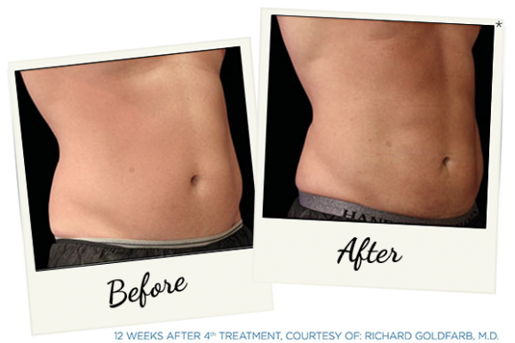 Before & After Pictures by Emsculpt® Providers - Burn Fat & Build Muscle