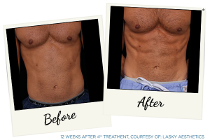 Before & After Pictures by Emsculpt® Providers - Burn Fat & Build Muscle