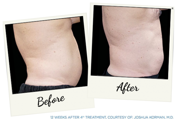 Before & After Pictures by Emsculpt® Providers - Burn Fat & Build Muscle