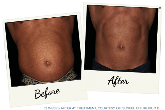 Before & After Pictures by Emsculpt® Providers - Burn Fat & Build Muscle
