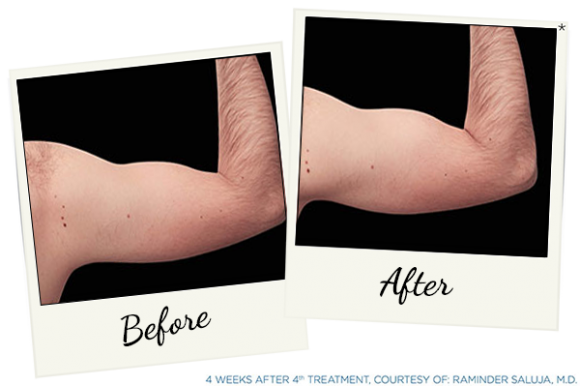 Before And After Pictures By Emsculpt® Providers Burn Fat And Build Muscle